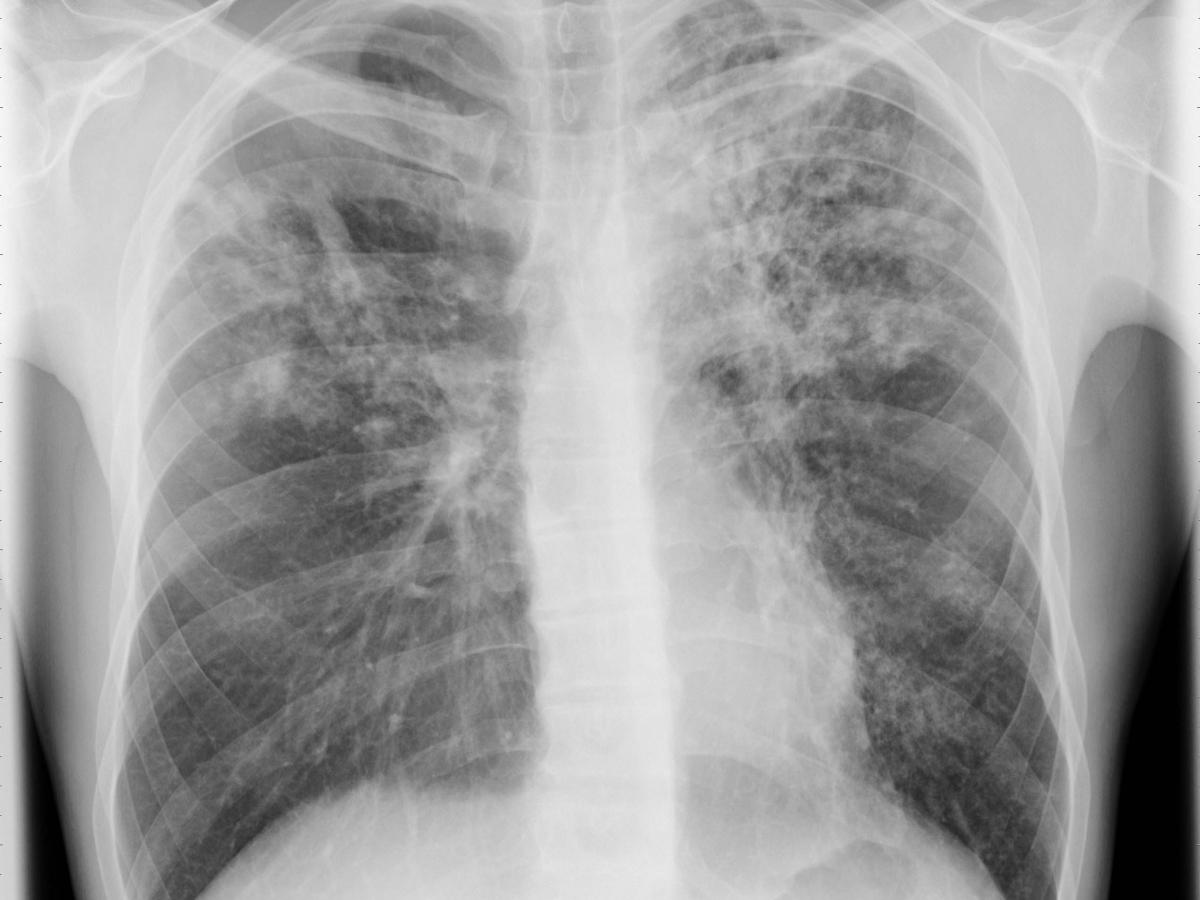 Santander implementa tecnologías para prevenir la tuberculosis | Radio ...